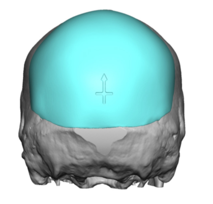 Plastic Surgery Case Study - Back Of Head Reshaping With Occipital Knob ...