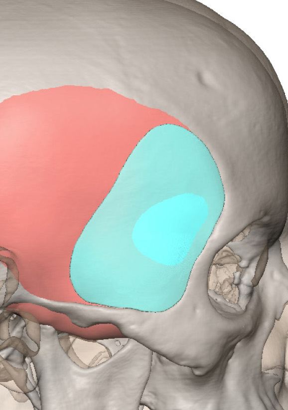 Technical Strategies - The High Anterior Incision for Temporal Implant ...
