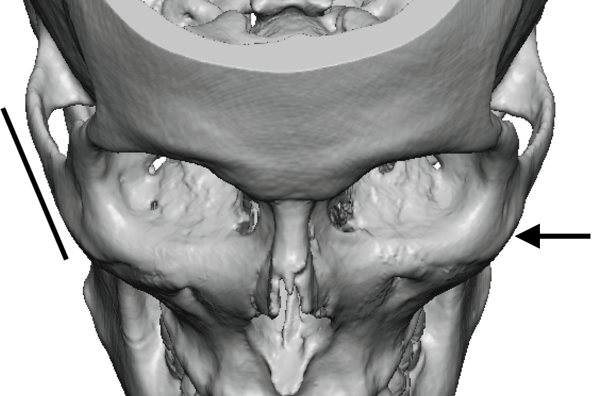 The Basic Concepts of Achieving The High Cheekbone Look With Custom ...