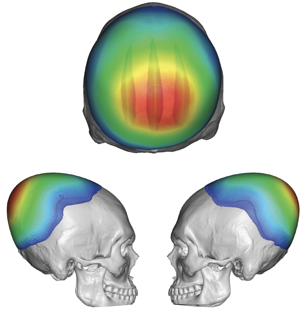 Plastic Surgery Case Study - Large Custom Two Layer Low Durometer Skull ...