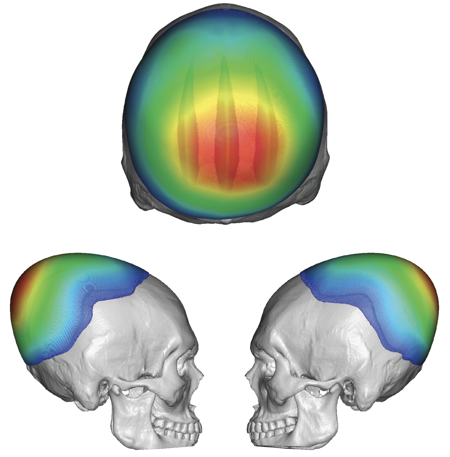 Plastic Surgery Case Study - Large Custom Two Layer Low Durometer Skull ...
