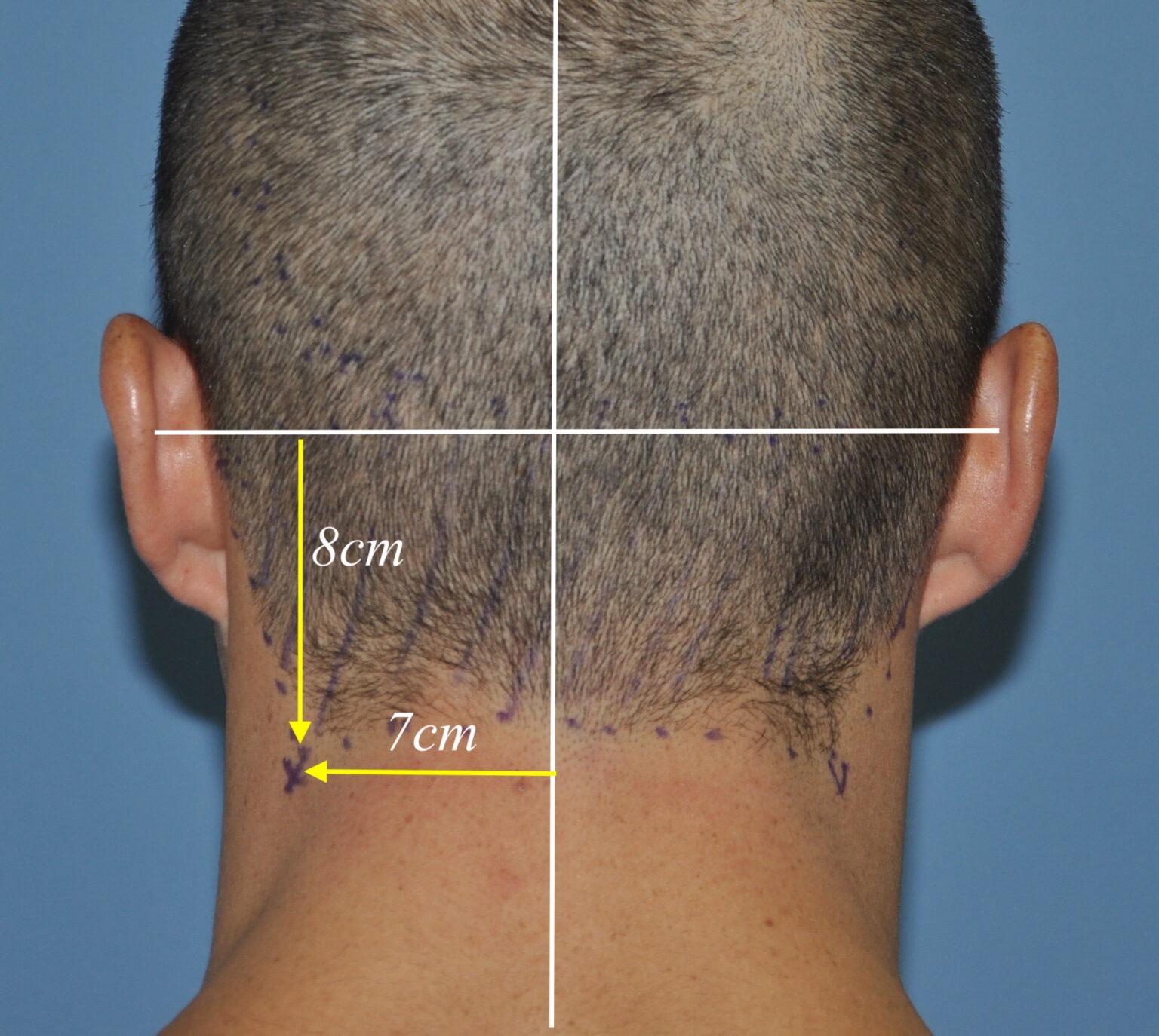 The Anatomic Location of the Spinal Accessory Nerve in Webbed Neck ...