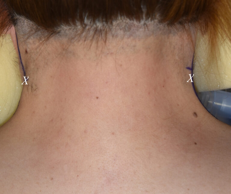 The Anatomic Location of the Spinal Accessory Nerve in Webbed Neck ...