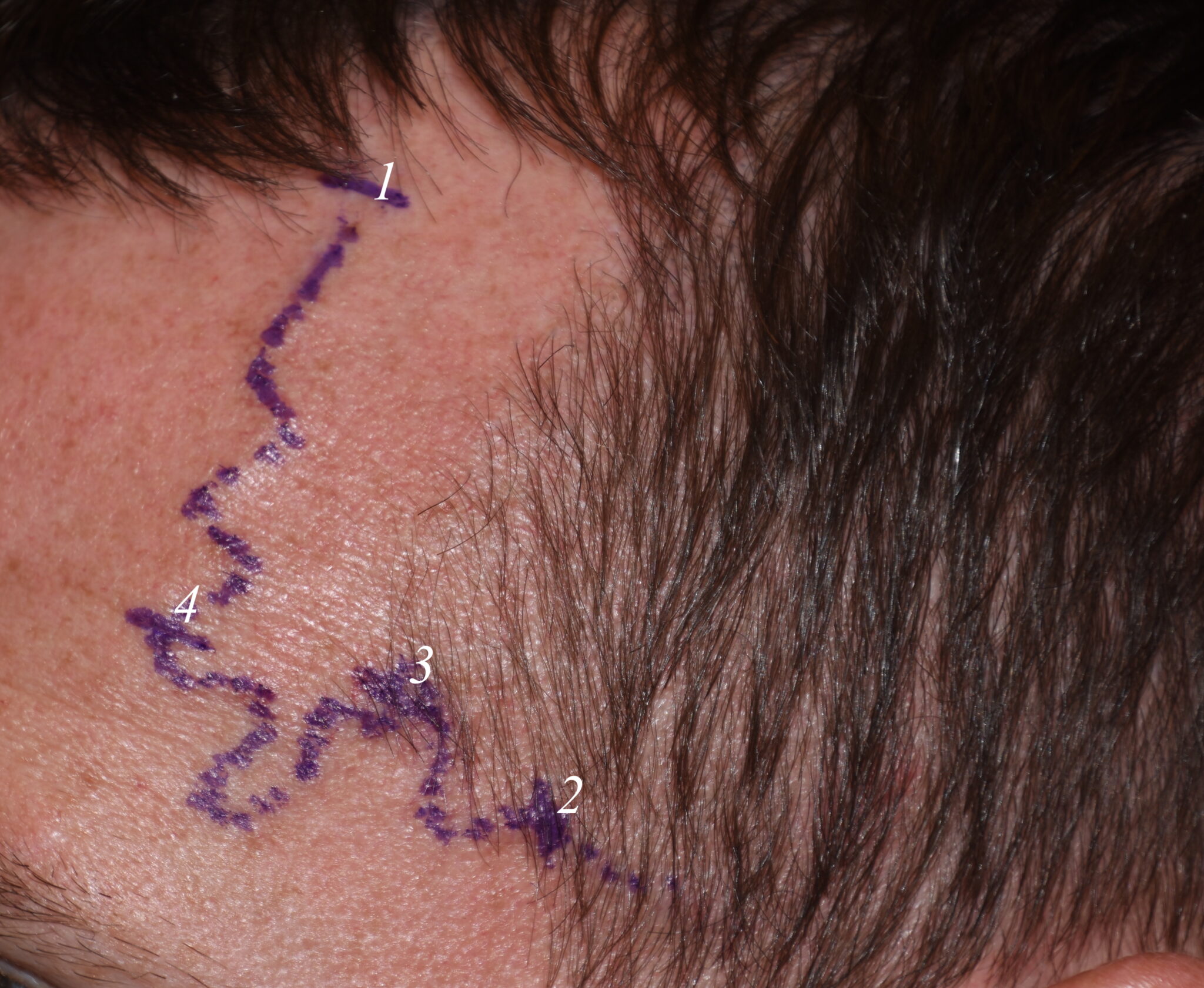 Technical Strategies - Sequencing Multi-Level Temporal Artery Ligations ...