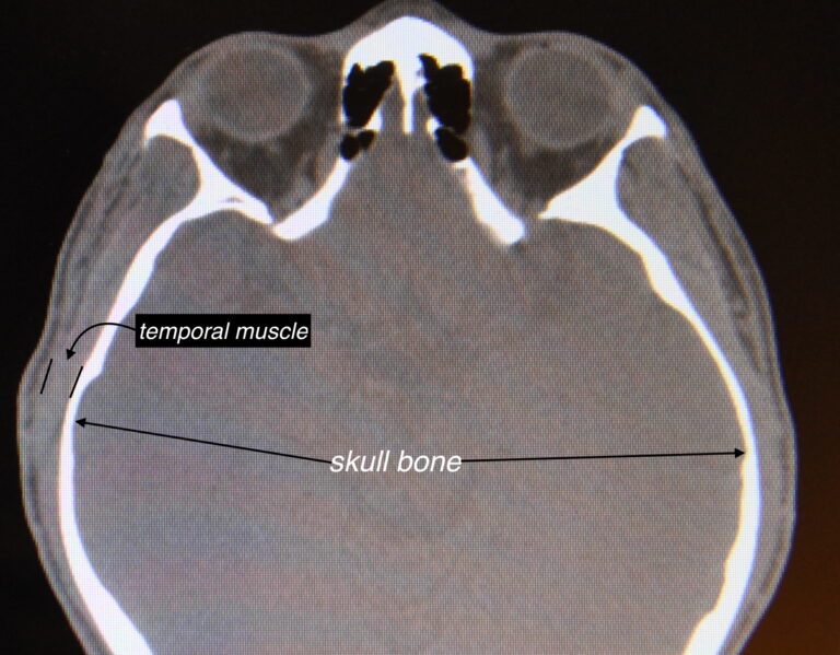 The Anatomic Basis For Temporal Muscle Excision in Head Width Reduction ...