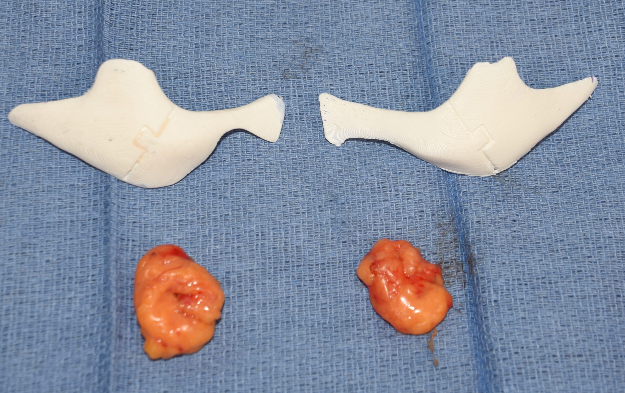 Combining custom infraorbital-malar cheek implants with buccal ...