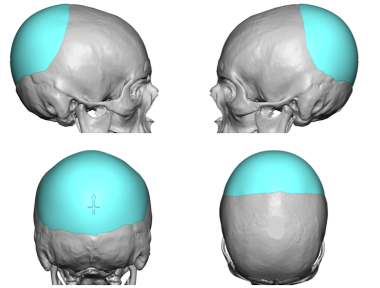 Custom skull implant augmentation design for back of head augmentation ...