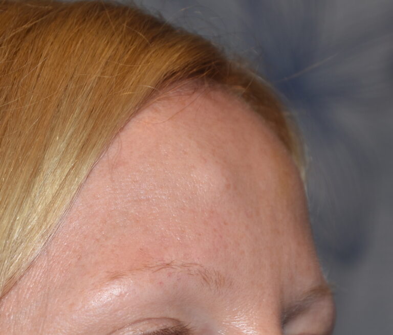 Plastic Surgery Case Study - Scarless Endoscopic Removal Of Forehead ...