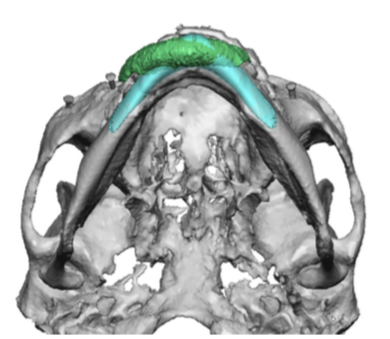 Standard vs custim chin implant design submental view Dr Barry Eppley ...