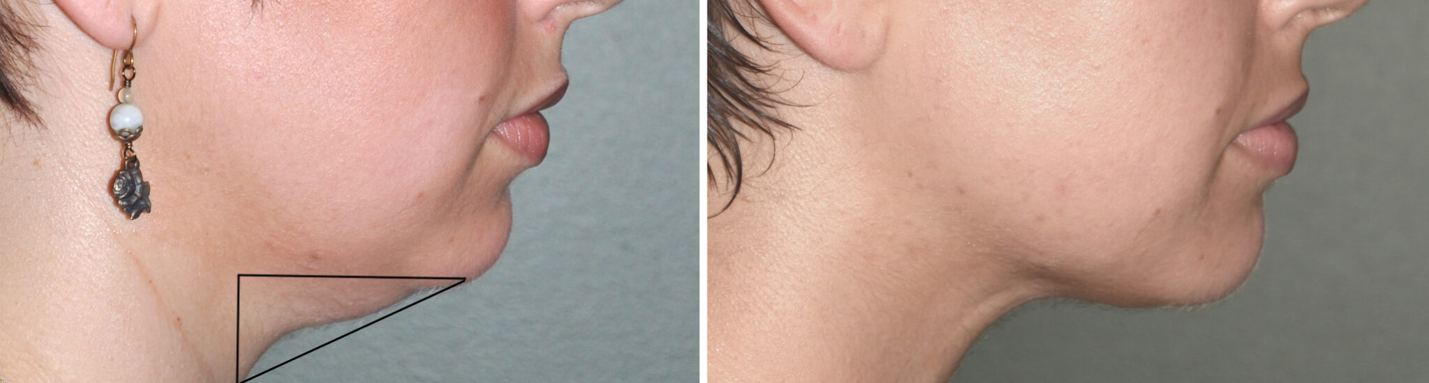 The Cervicicomental Incision-Based Necklift as a Modification of the ...