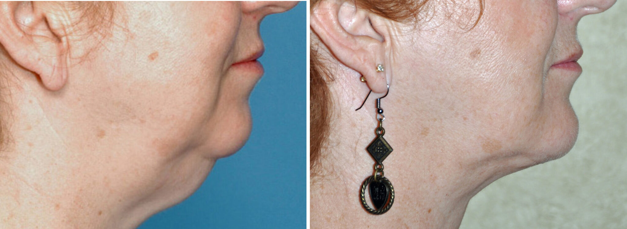 The Cervicicomental Incision-Based Necklift as a Modification of the ...