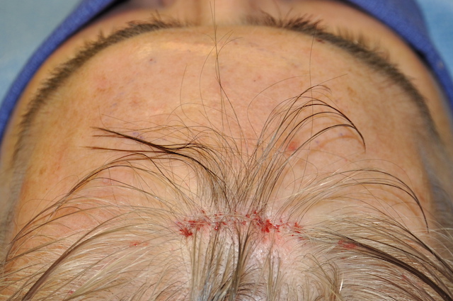 custom central suprabrow bone break forehead implant incision closure ...