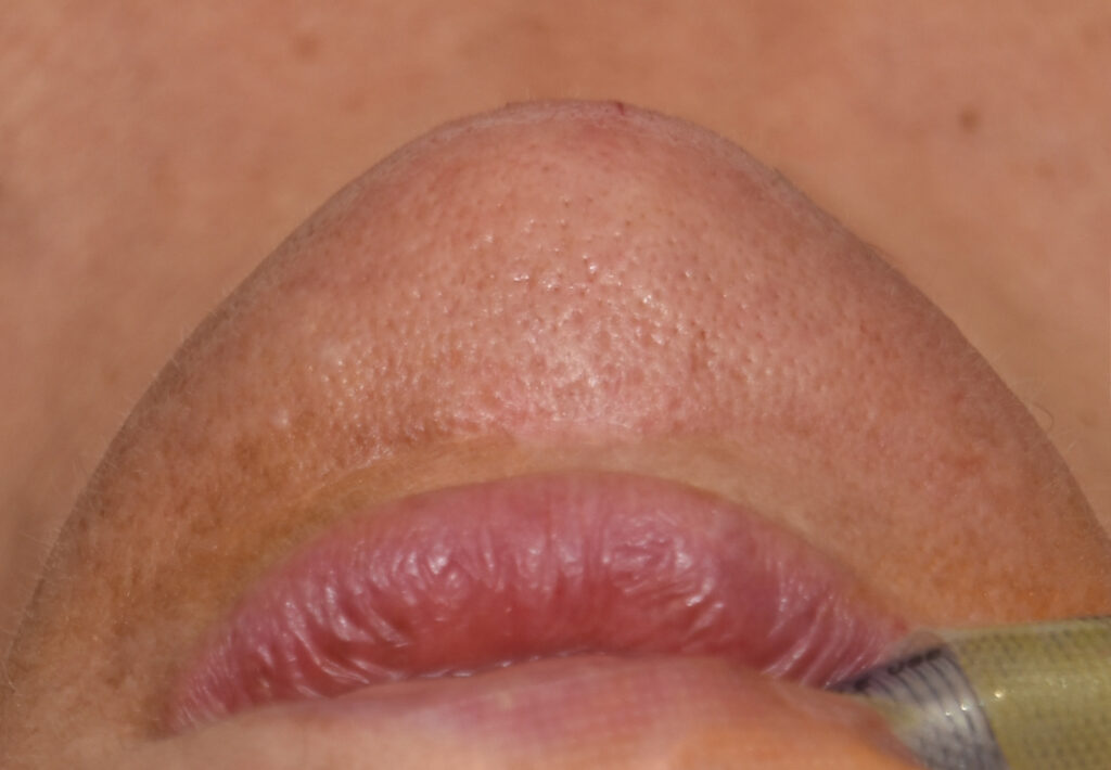 Plastic Surgery Case Study - Custom Chin Implant Replacement for ...