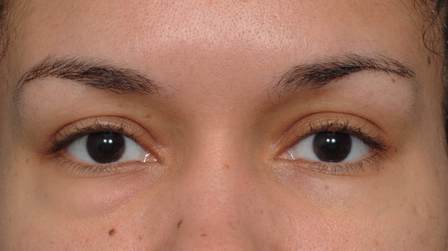 The Role of the Transconjunctival Lower Bleharoplasty in Improvement of ...