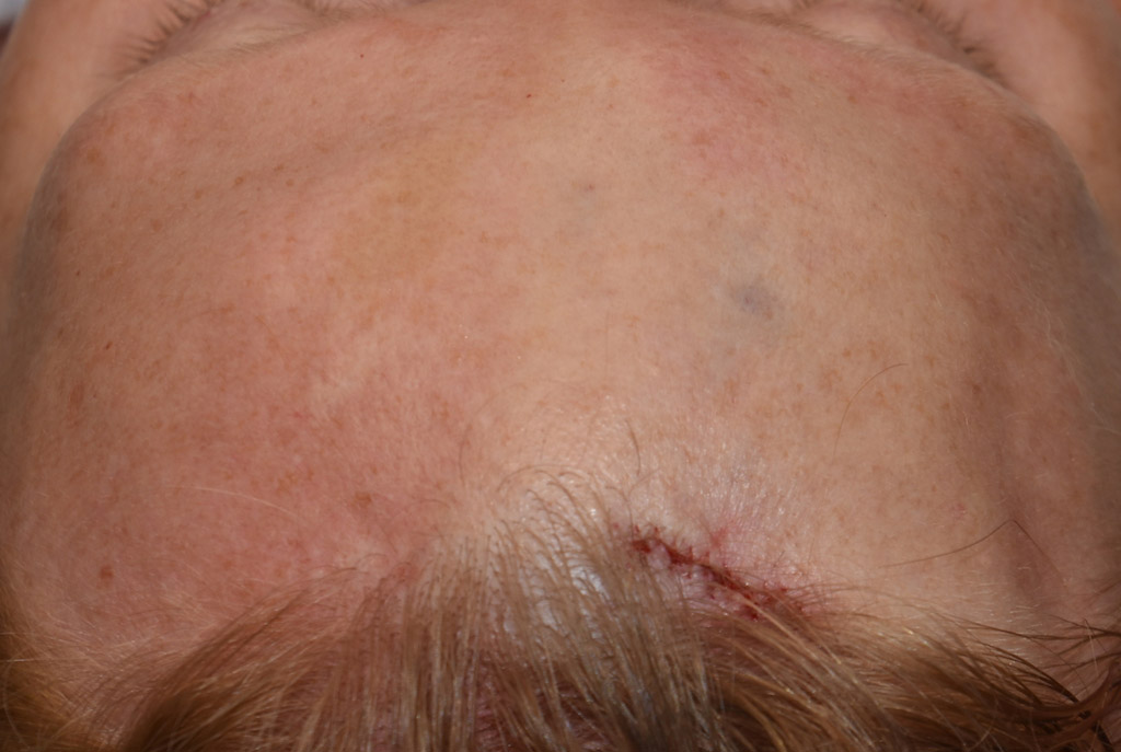 Plastic Surgery Case Study - Scarless Endoscopic Removal Of Forehead ...