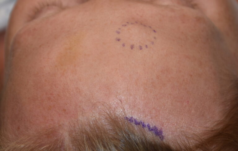 Plastic Surgery Case Study - Scarless Endoscopic Removal Of Forehead ...