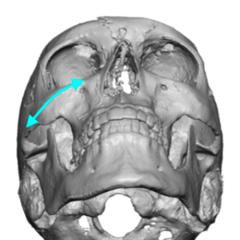 Achieving The High CheekBone Look With A Combination of Custom Cheek ...