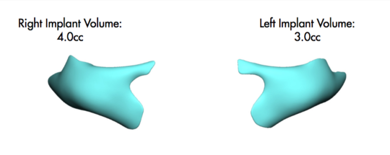 Basic Concepts in Custom Cheek and Jawline Implants for Facial ...