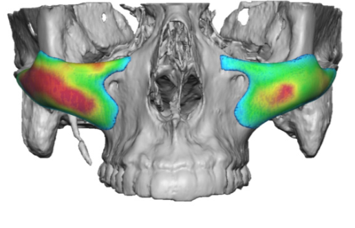 male custom cheek implants front view Dr Barry Eppley Indianapois ...
