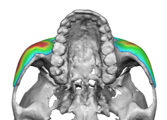 Basic Concepts in Custom Cheek and Jawline Implants for Facial ...