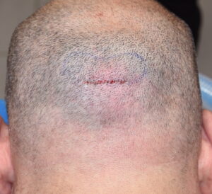 Plastic Surgery Case Study - Occipital Knob Skull Reduction With A ...