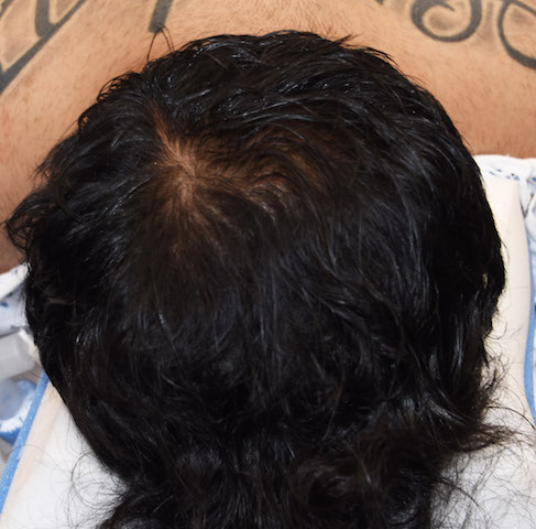 Plastic Surgery Case Study - Back of Head Flat Spot Correction with a ...