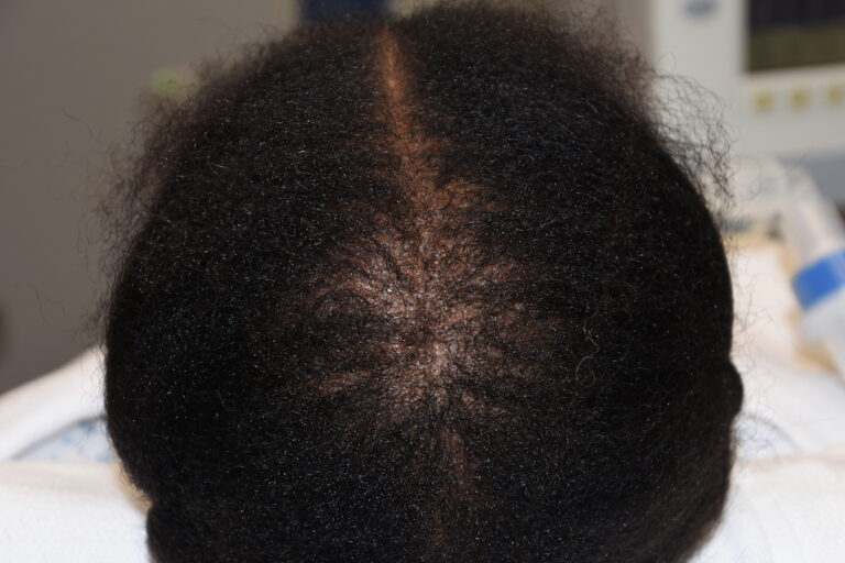 well healed scalp scar from previous skull implant dr bary eppley ...