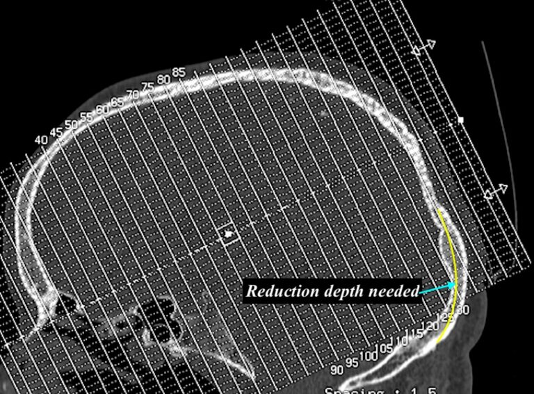 Plastic Surgery Case Study - Occipital Skull Reduction with Scalp Tuck ...