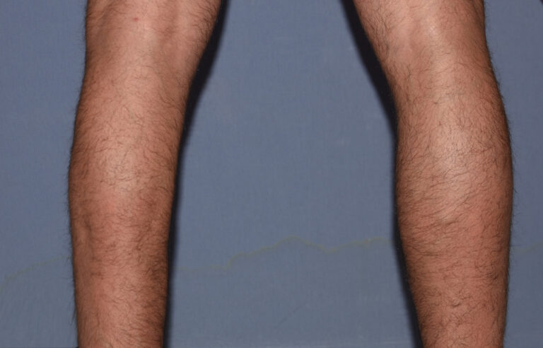 Plastic Surgery Case Study - Calf Implants for Symmetry Improvement ...