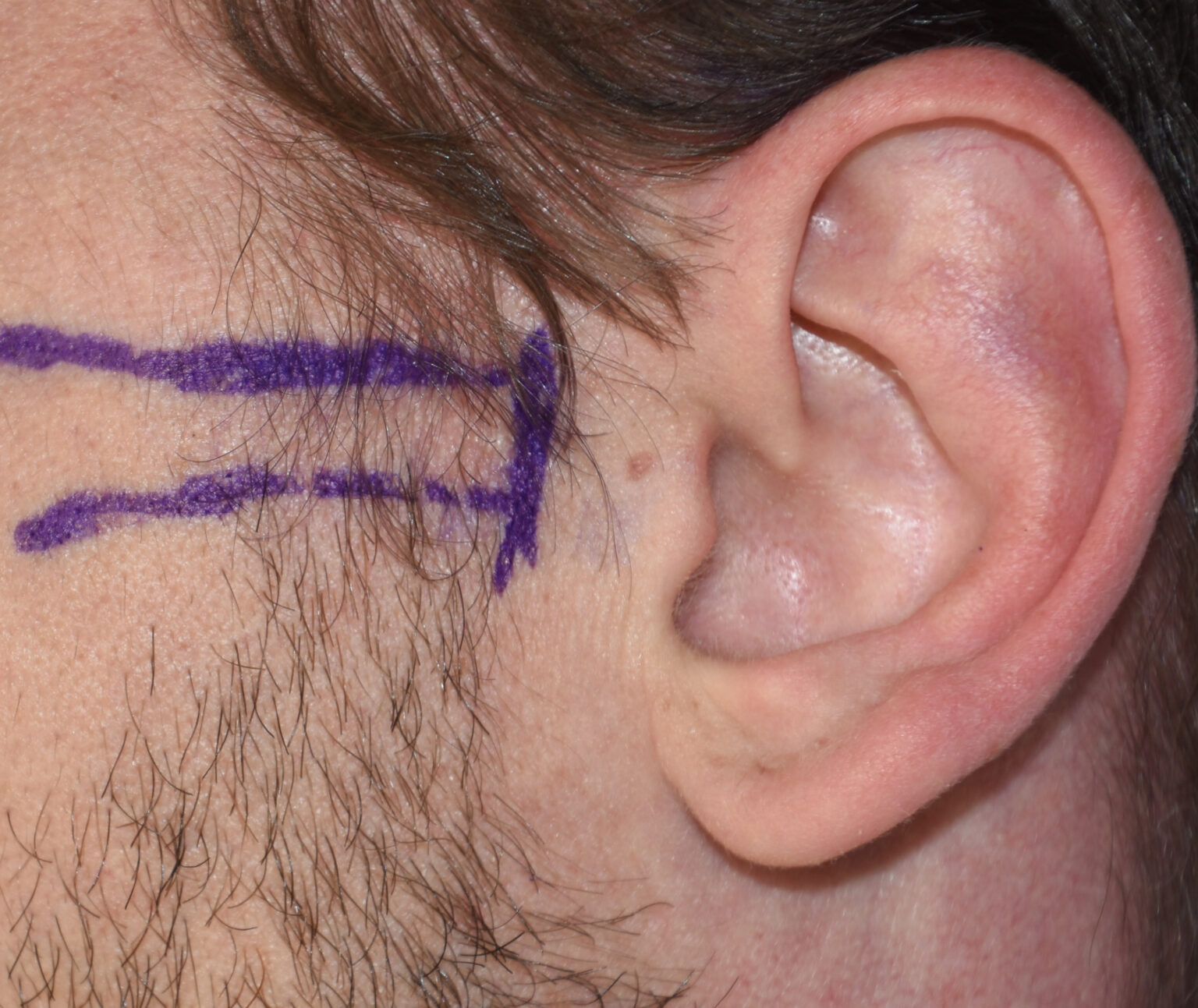 Technical Strategies - The Posterior Zygomatic Arch Osteotomy in ...