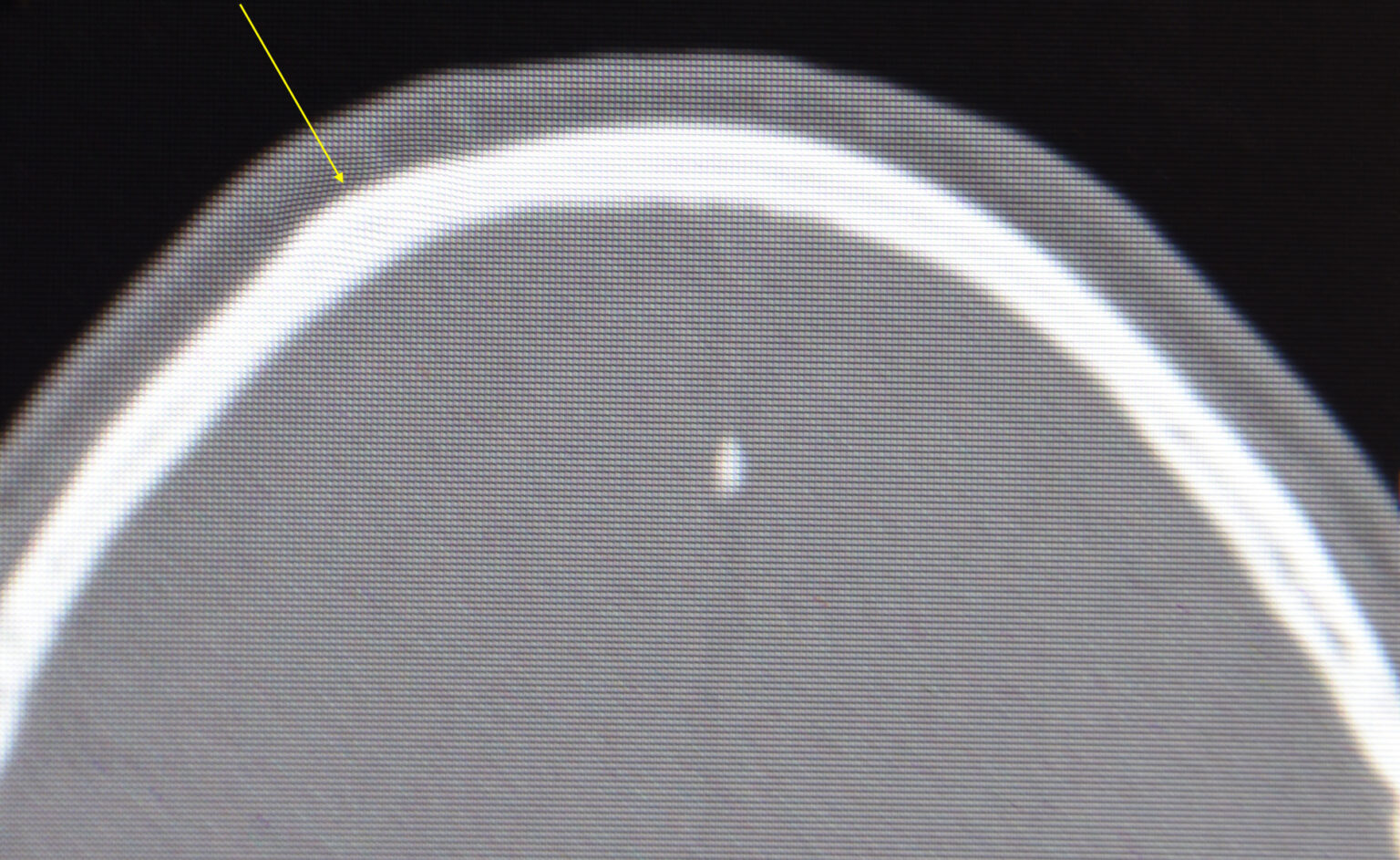 Plastic Surgery Case Study - Unilateral Forehead Horn (Frontal Eminence ...