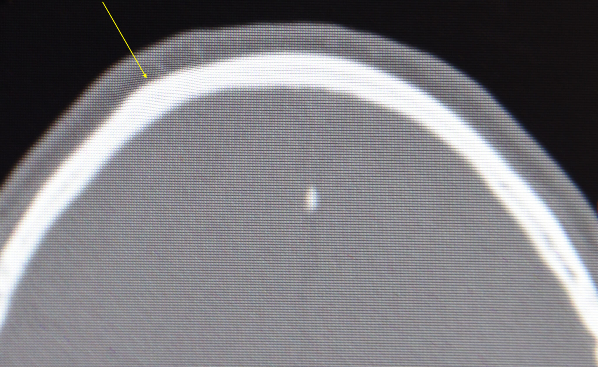 Plastic Surgery Case Study - Unilateral Forehead Horn (Frontal Eminence ...