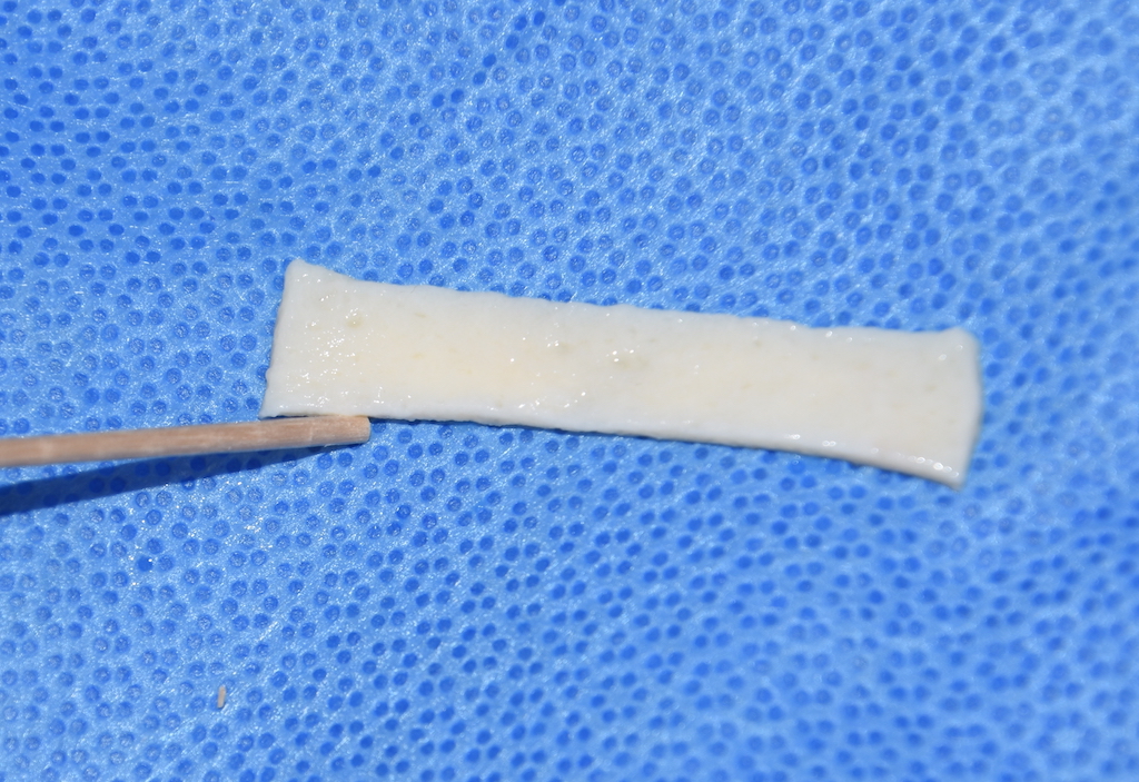 Love Band Surgery (Aegyo Sal Surgery) for Lower Eyelid Enhancement ...