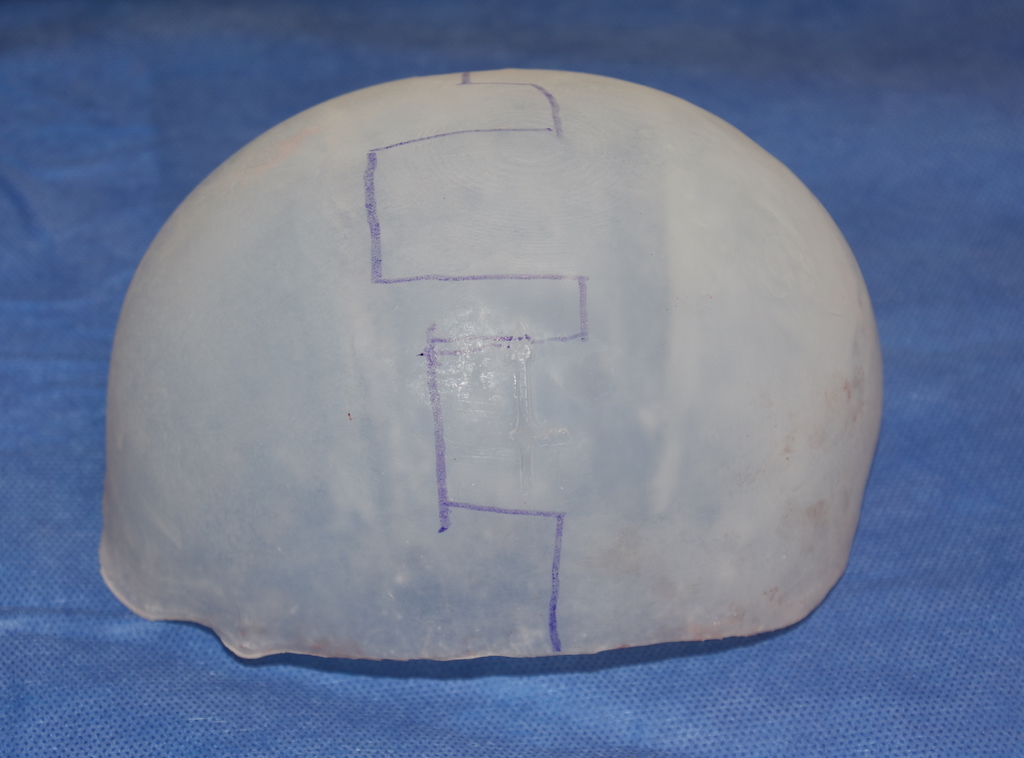 Technical Strategies - Custom Skull Implant Split Techniques For ...