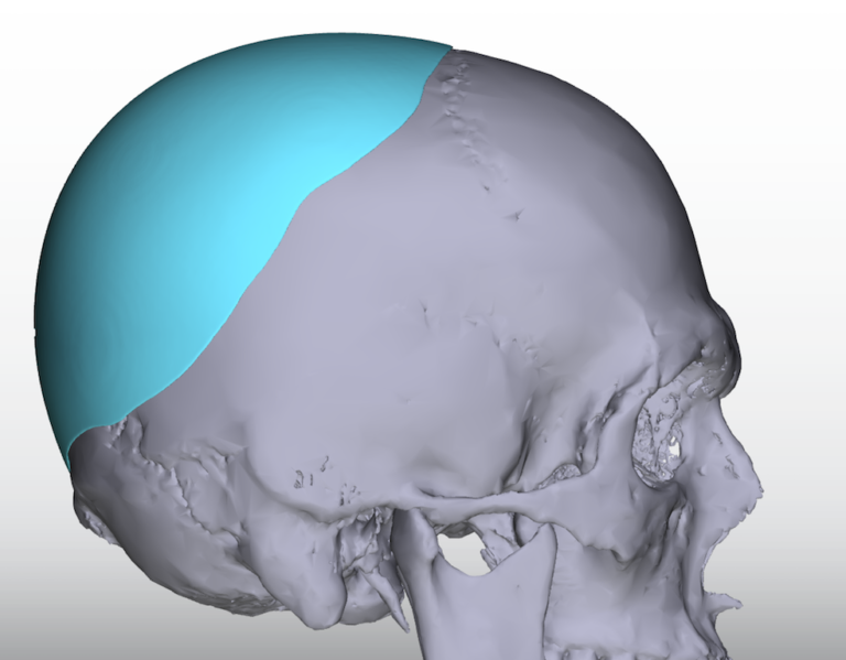 Concepts in Custom Skull Implants For Flat Back Of The Head ...