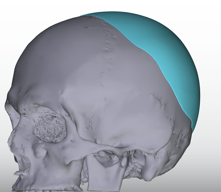 custom skull implant for flat back of the head oblique view Dr Barry ...