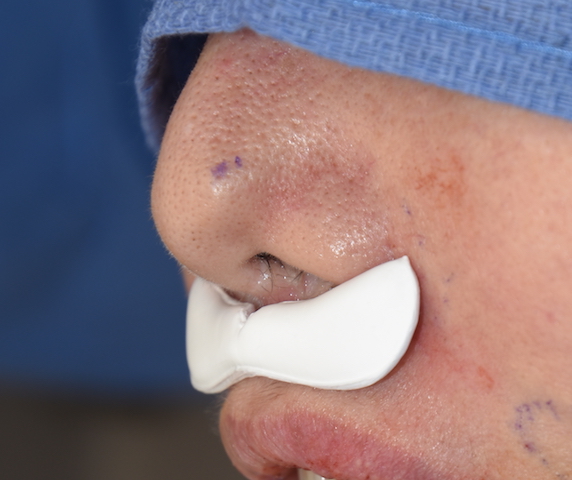 Pyriform Aperture Nasal Base Augmentation Using A Performed ePTFE ...