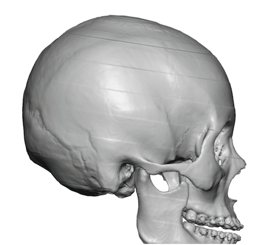 Plastic Surgery Case Study - Custom Skull Implants for Female Crown of ...