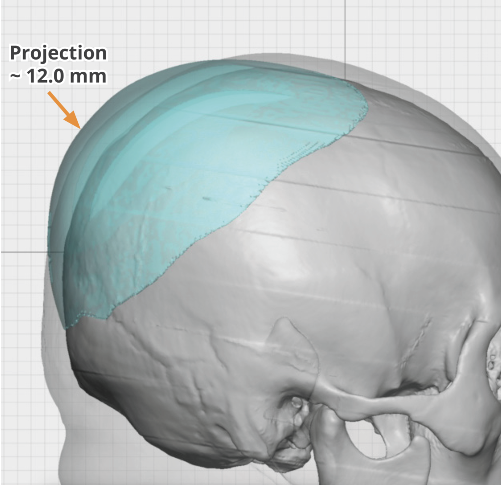 Concepts in Custom Skull Implants For Flat Back Of The Head ...