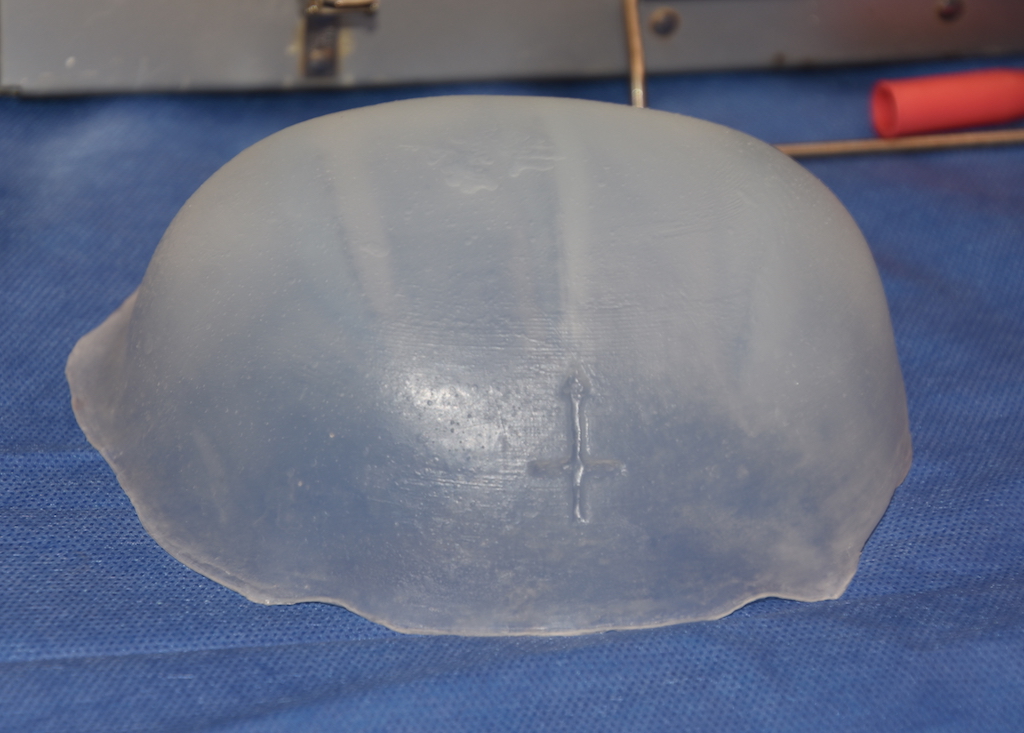 Plastic Surgery Case Study - Custom Skull Implants for Female Crown of ...