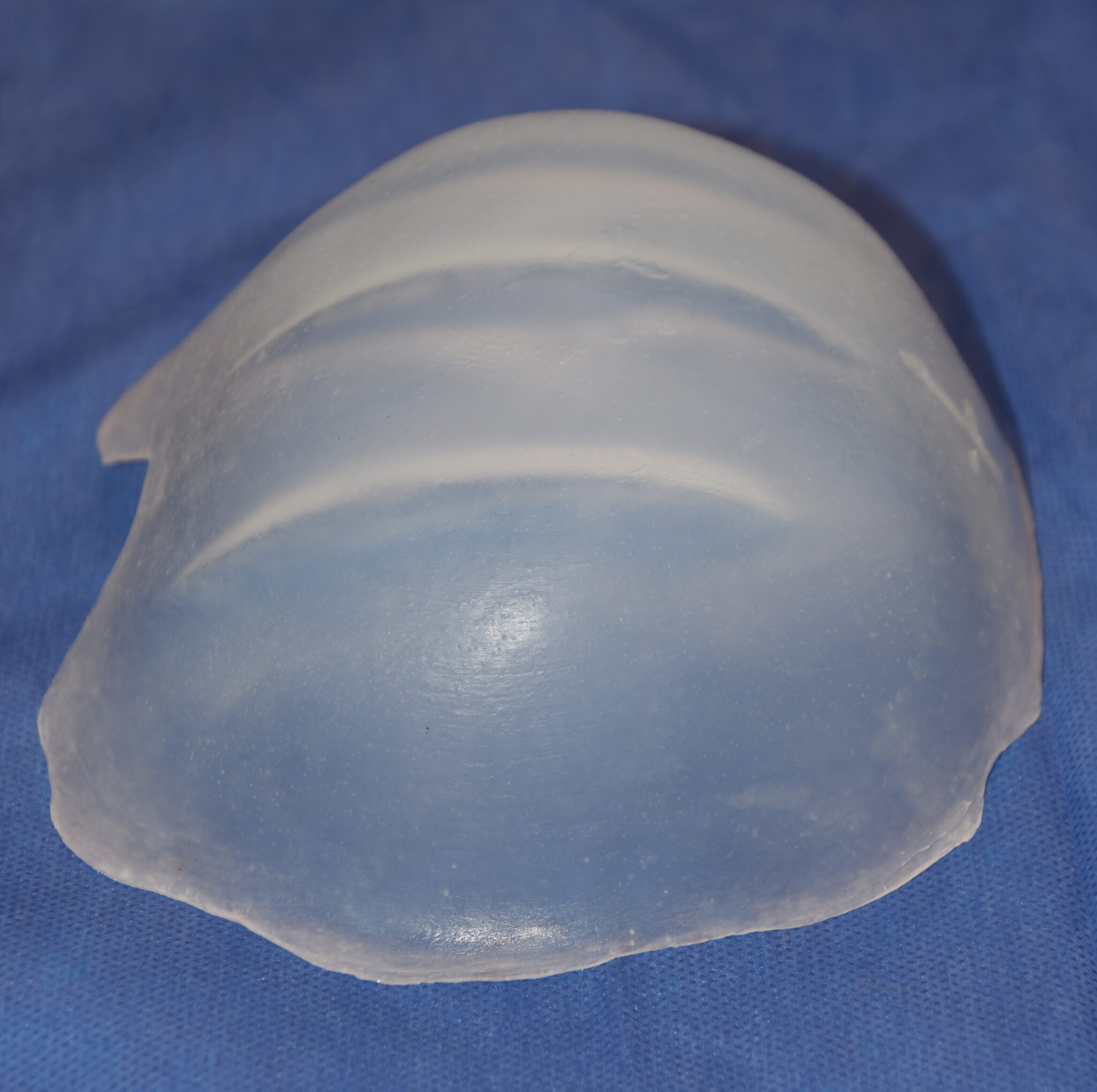 Plastic Surgery Case Study - Custom Skull Implants for Female Crown of ...