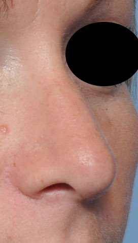 Plastic Surgery Case Study - Secondary Rhinoplasty Correction of the ...