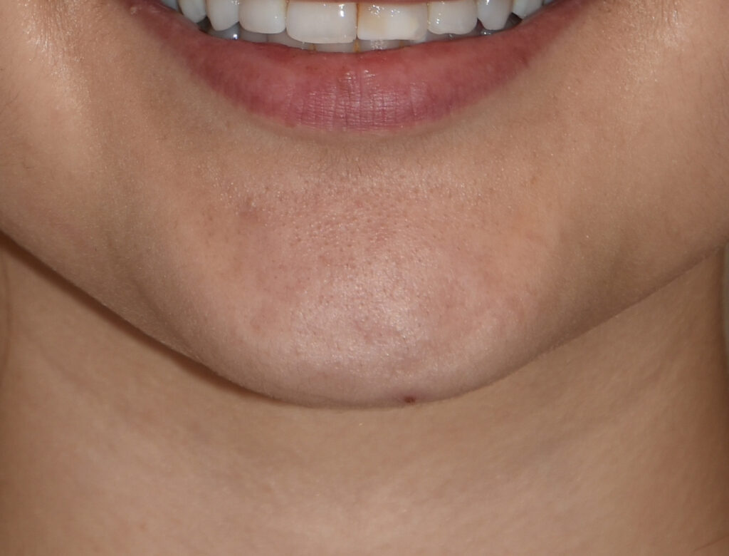 Plastic Surgery Case Study - The Submental Approach to Hyperdynamic ...