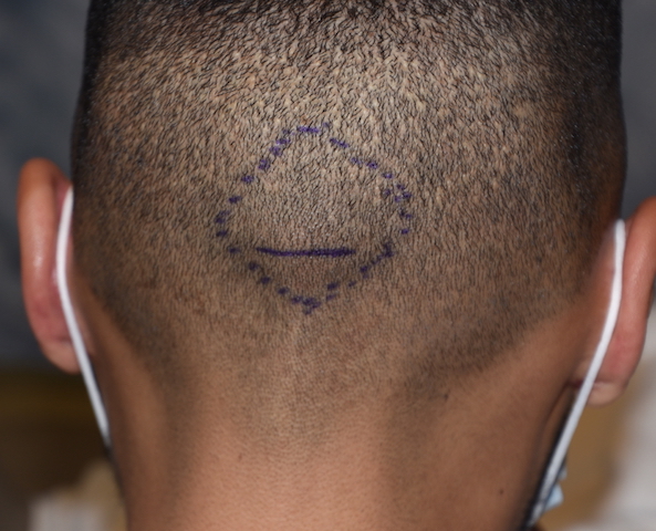 male occipital knob skull redeuction incision marking Dr Barry Eppley ...