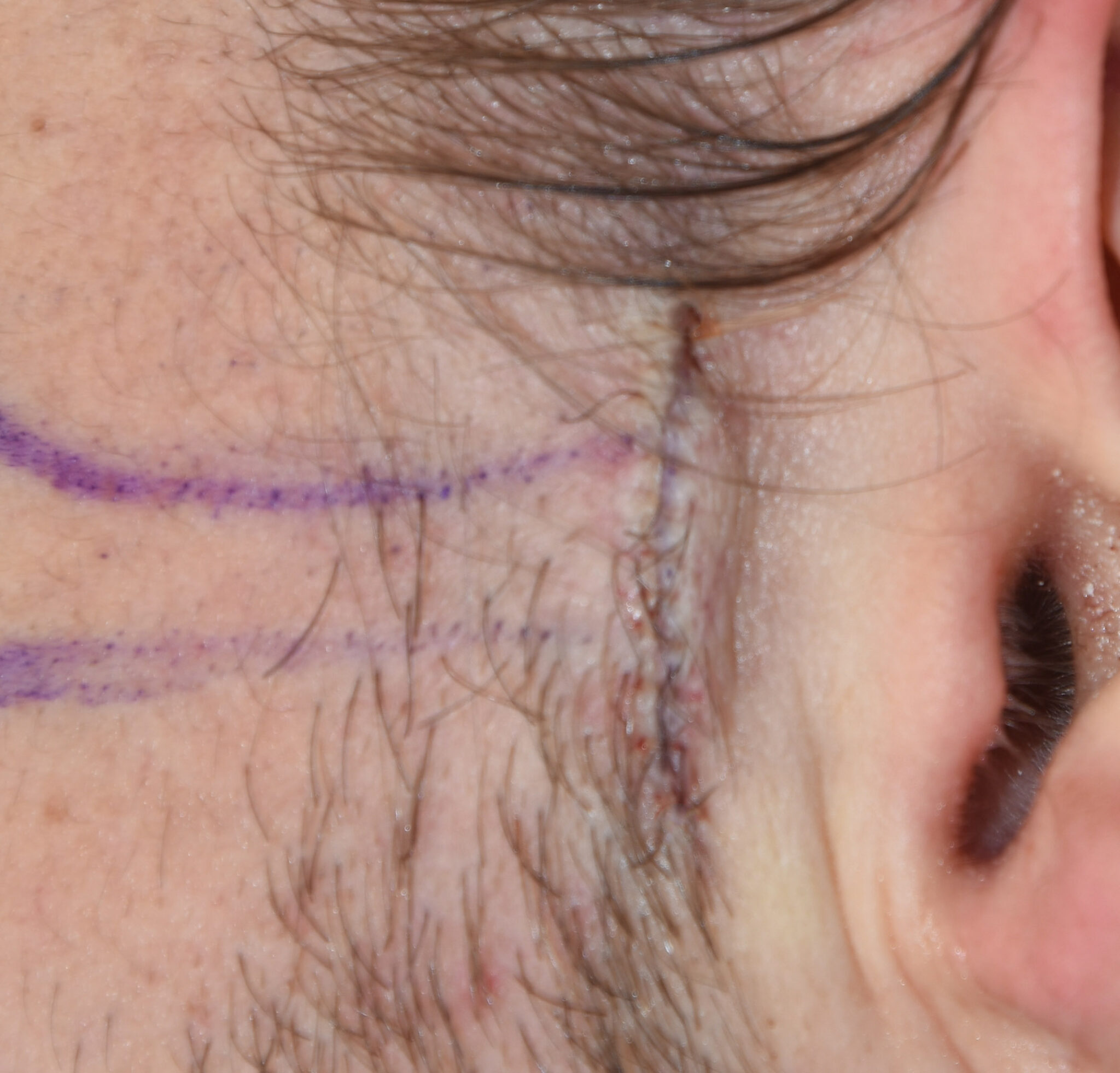 Technical Strategies - The Posterior Zygomatic Arch Osteotomy in ...