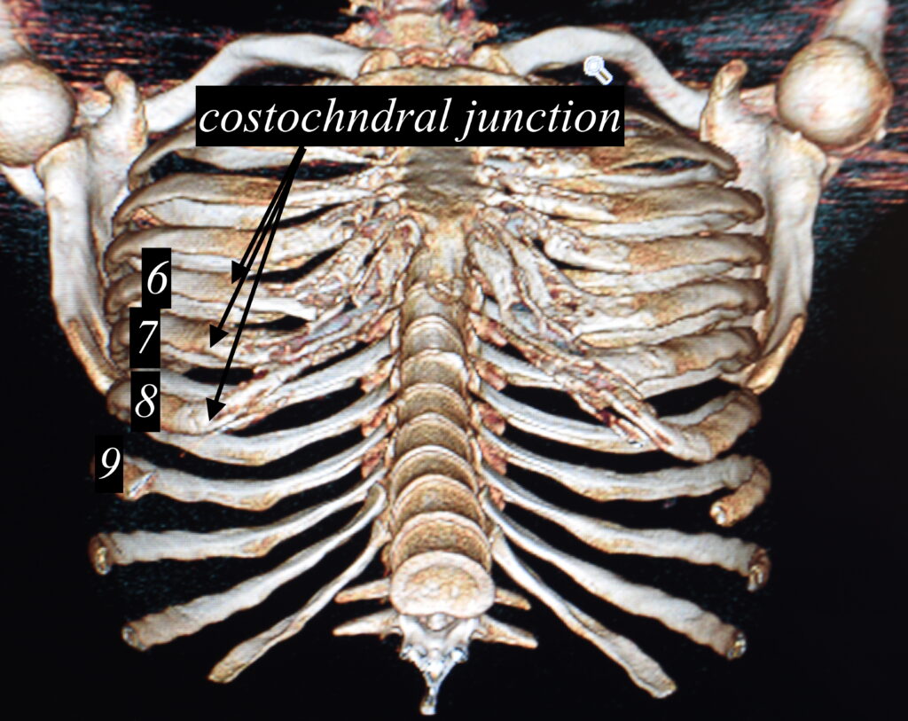 Subcostal Margin Rib Removal Technique for Protrusion Reduction ...