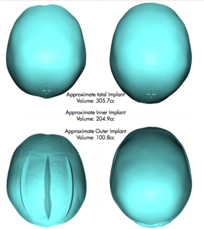 Advanced Concepts in Two-Stage Large Skull Augmentations - Explore ...