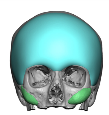 Plastic Surgery Case Study - Custom Forehead Implant with Temporal ...
