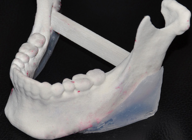 Custom Vertical Lengthening Jaw Angle Implant desigtn Dr Barry Eppley ...