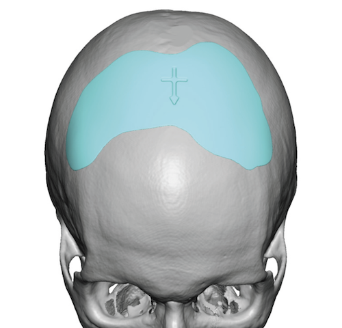 Custom Skull Implants and The Scalp Incisions Needed To Place Them ...